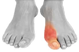 ¿Qué Síntomas tiene la Gota? - MexiWoman